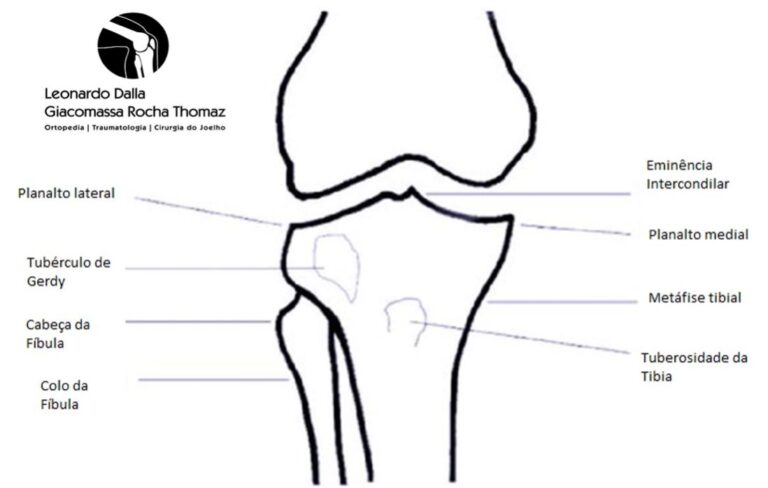 Tratamento de Fraturas do Planalto Tibial - Dr. Leonardo Rocha Thomaz