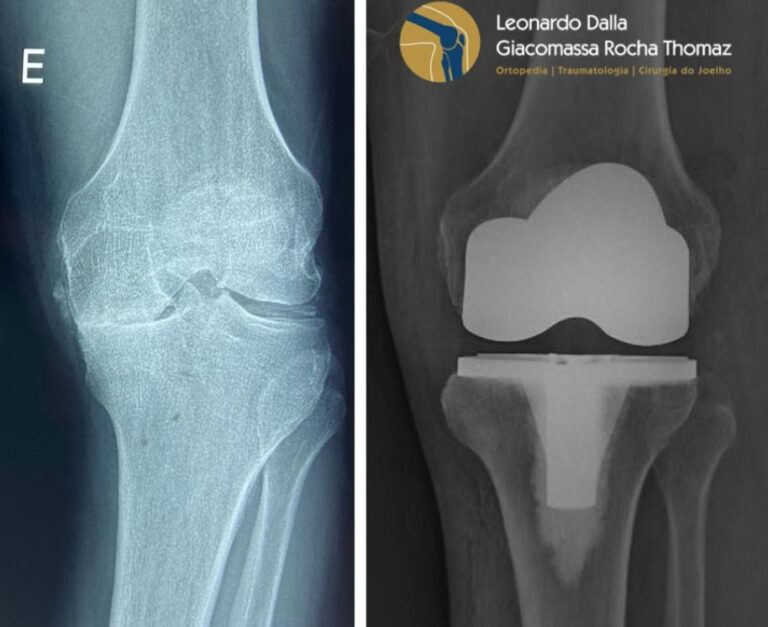 Artrose do Joelho - Dr. Leonardo Rocha Thomaz
