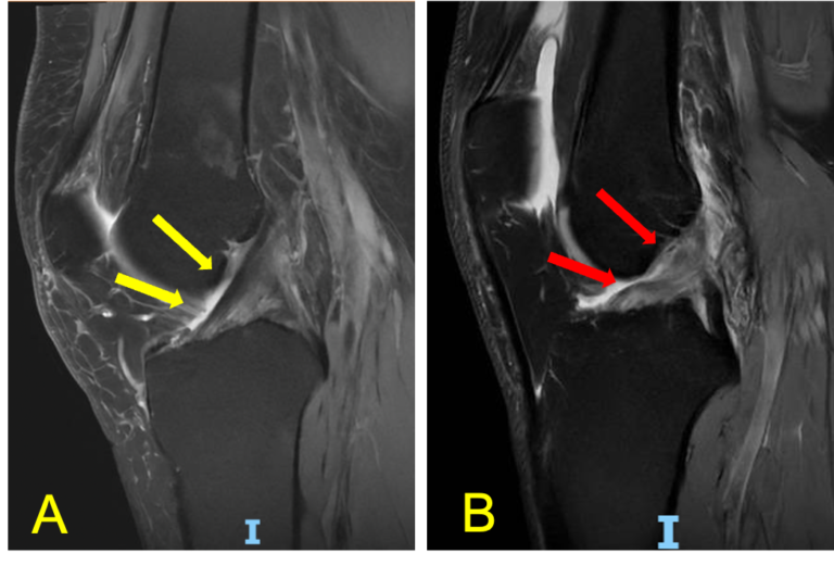 Lesão do Ligamento Cruzado Anterior - LCA - Dr. Leonardo Rocha Thomaz
