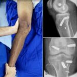 Ligamento Colateral Medial (LCM) - Dr. Leonardo Rocha Thomaz